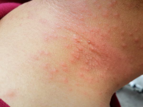 Processierups uitslag? Lees hier wat te doen!